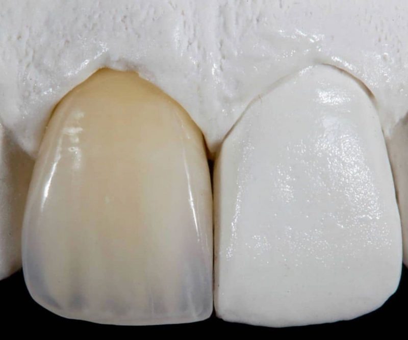 Metal Restorations - Al Shamil Dental Lab